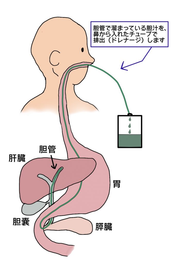 ENBD、ERBD、PTCD、EST、EPBD、ERCPの違いがわかる！胆管系の治療・検査 | 看護師になったシングルマザーのブログ