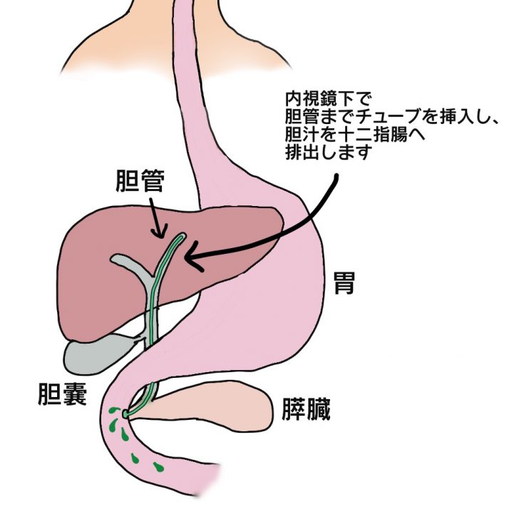 ENBD、ERBD、PTCD、EST、EPBD、ERCPの検査の違いと概要 - 看護師になったシングルマザーのブログ