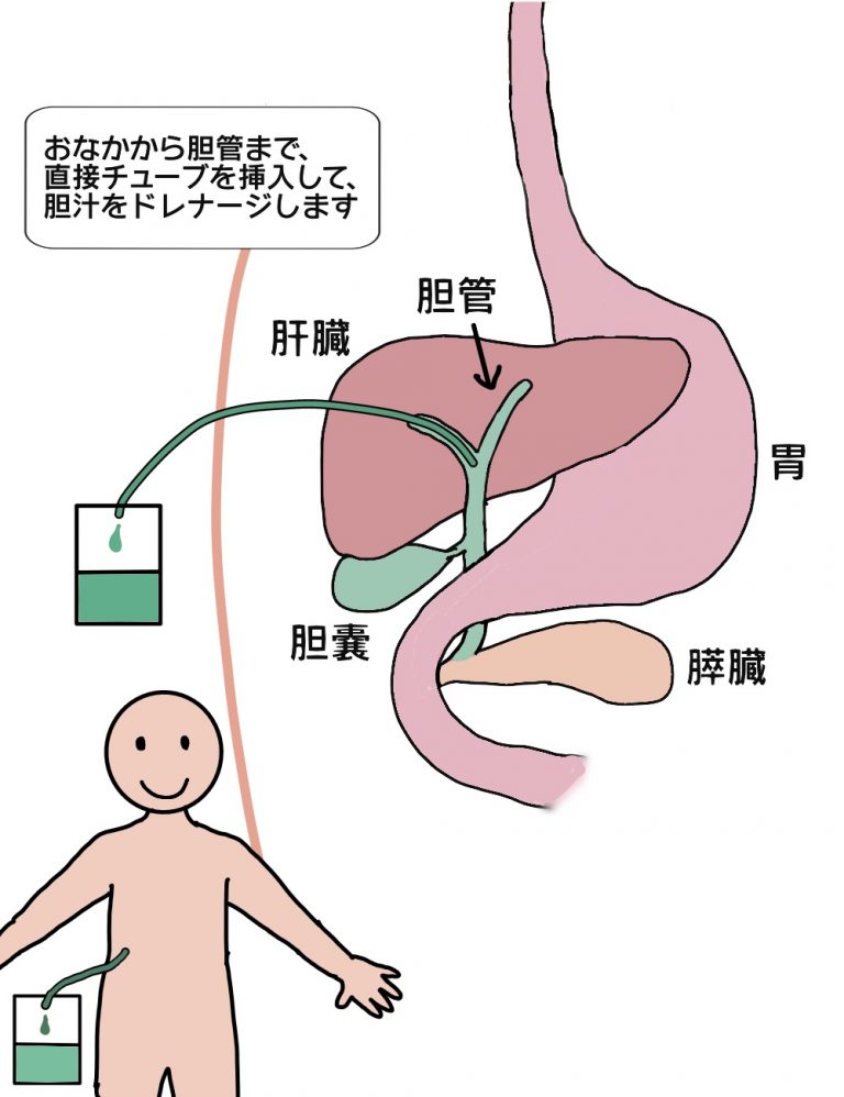 ENBD、ERBD、PTCD、EST、EPBD、ERCPの検査の違いと概要 - 看護師になったシングルマザーのブログ